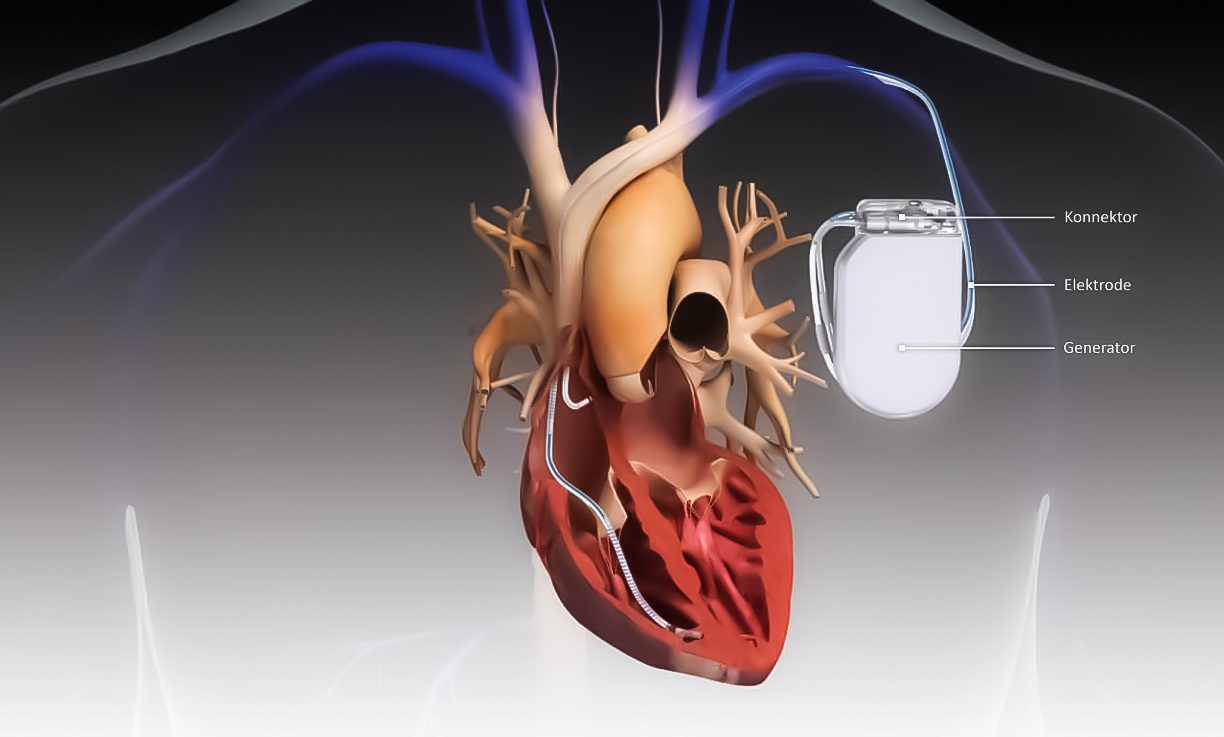 پیس میکر Pace Maker – دیجی جراح